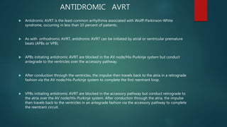 Antidromic Avrt