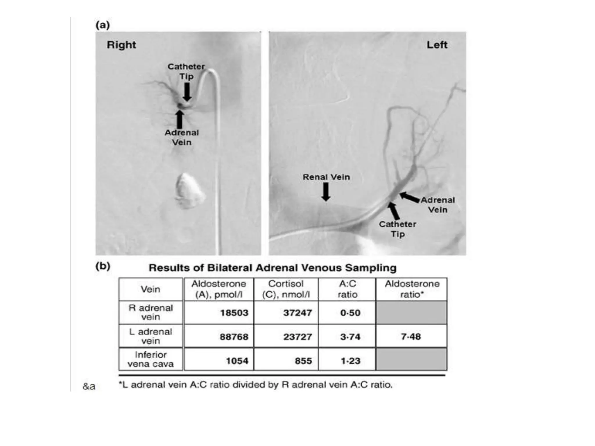 Primary hyperaldosteronism - arterial venous sampling cases | PPTX