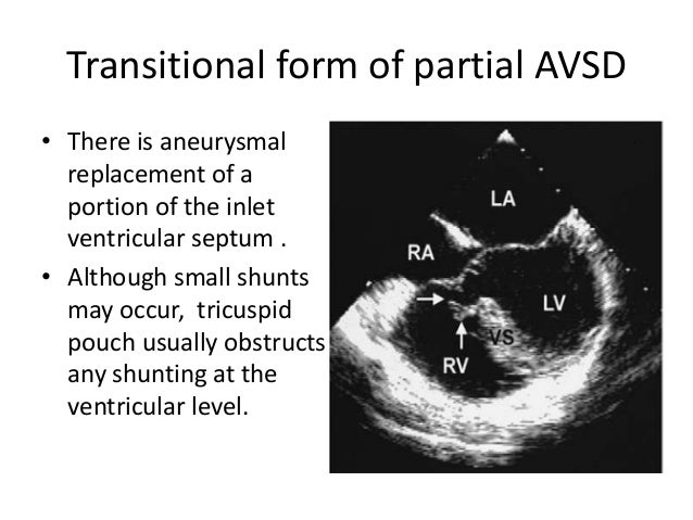 atio ventricular septal defects