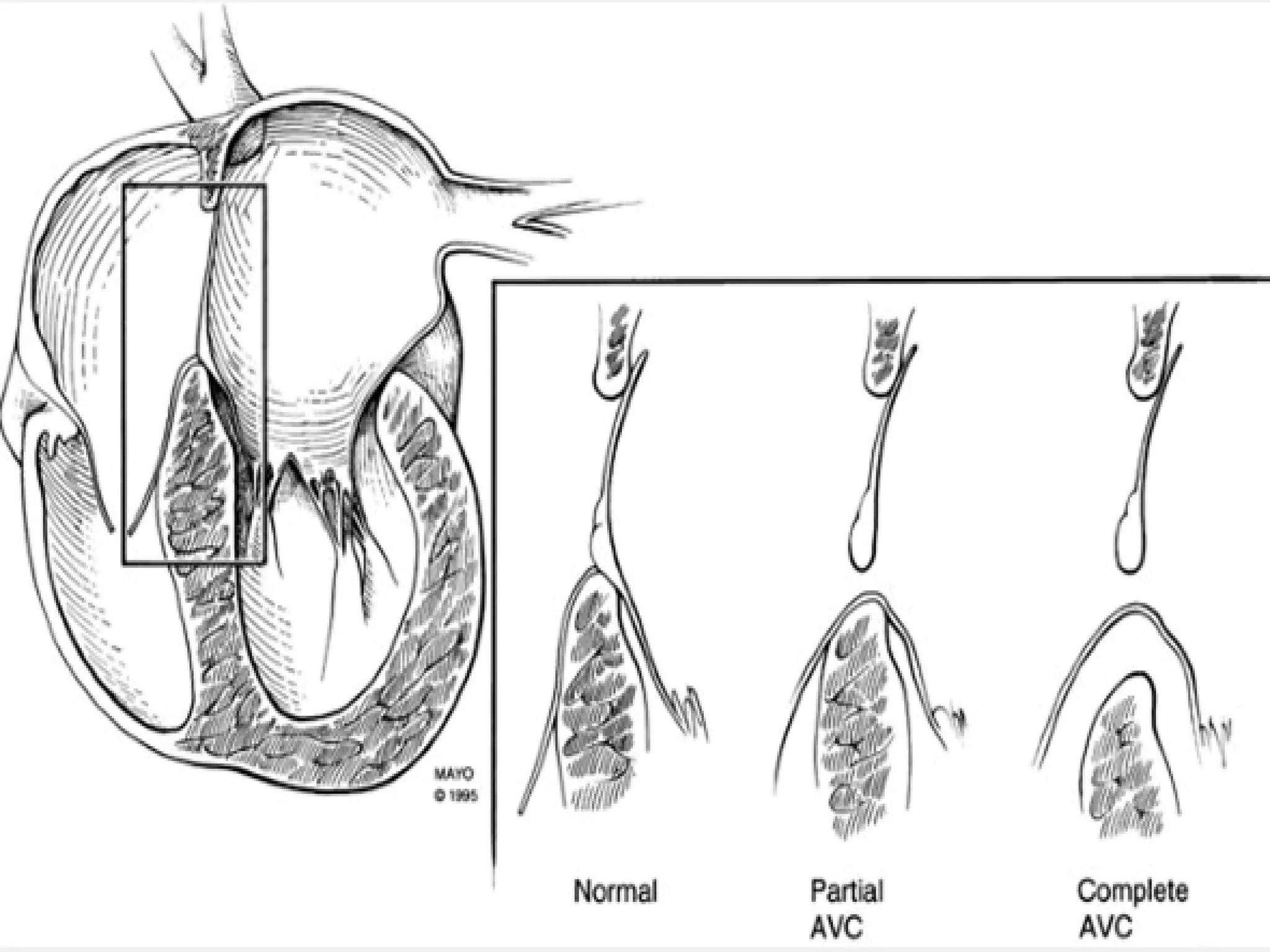 AV septal defects (AVCD) | PPT