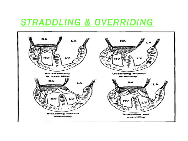 AV septal defects (AVCD) | PPT | Heart and Cardiovascular Diseases ...
