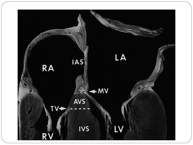 AV septal defects (AVCD) | PPT | Heart and Cardiovascular Diseases ...