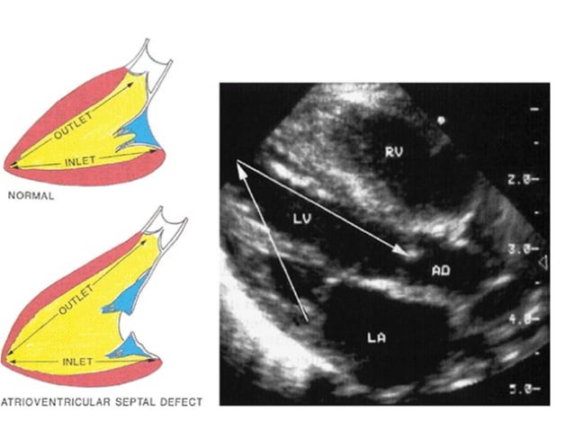 AV septal defects (AVCD) | PPT | Heart and Cardiovascular Diseases ...