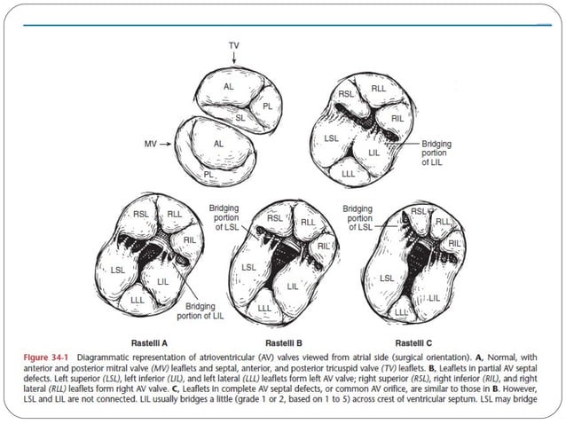 AV septal defects (AVCD) | PPT | Heart and Cardiovascular Diseases ...