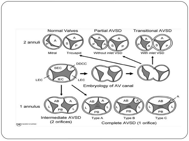 AV septal defects (AVCD)