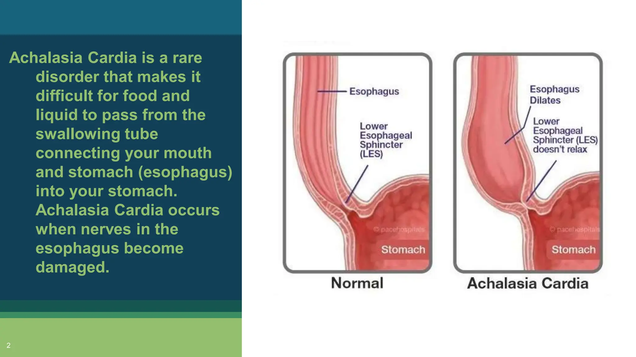 Achalasia Cardia | PPTX