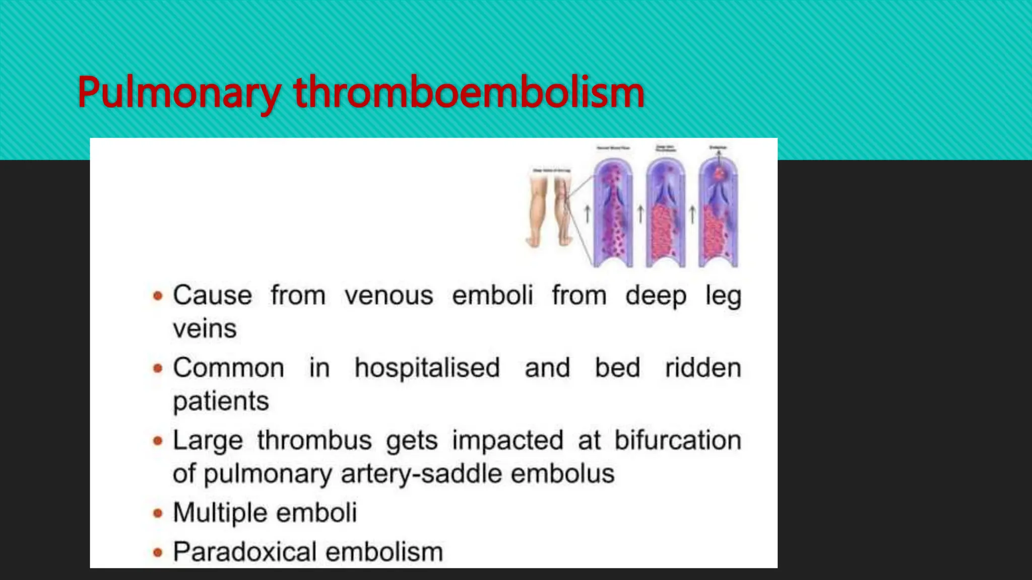 Post-operative thrombosis and embolism.pptx