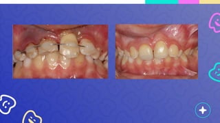 Avulsi dan Dislokasi pada Rongga Mulut dan gigi | PPTX