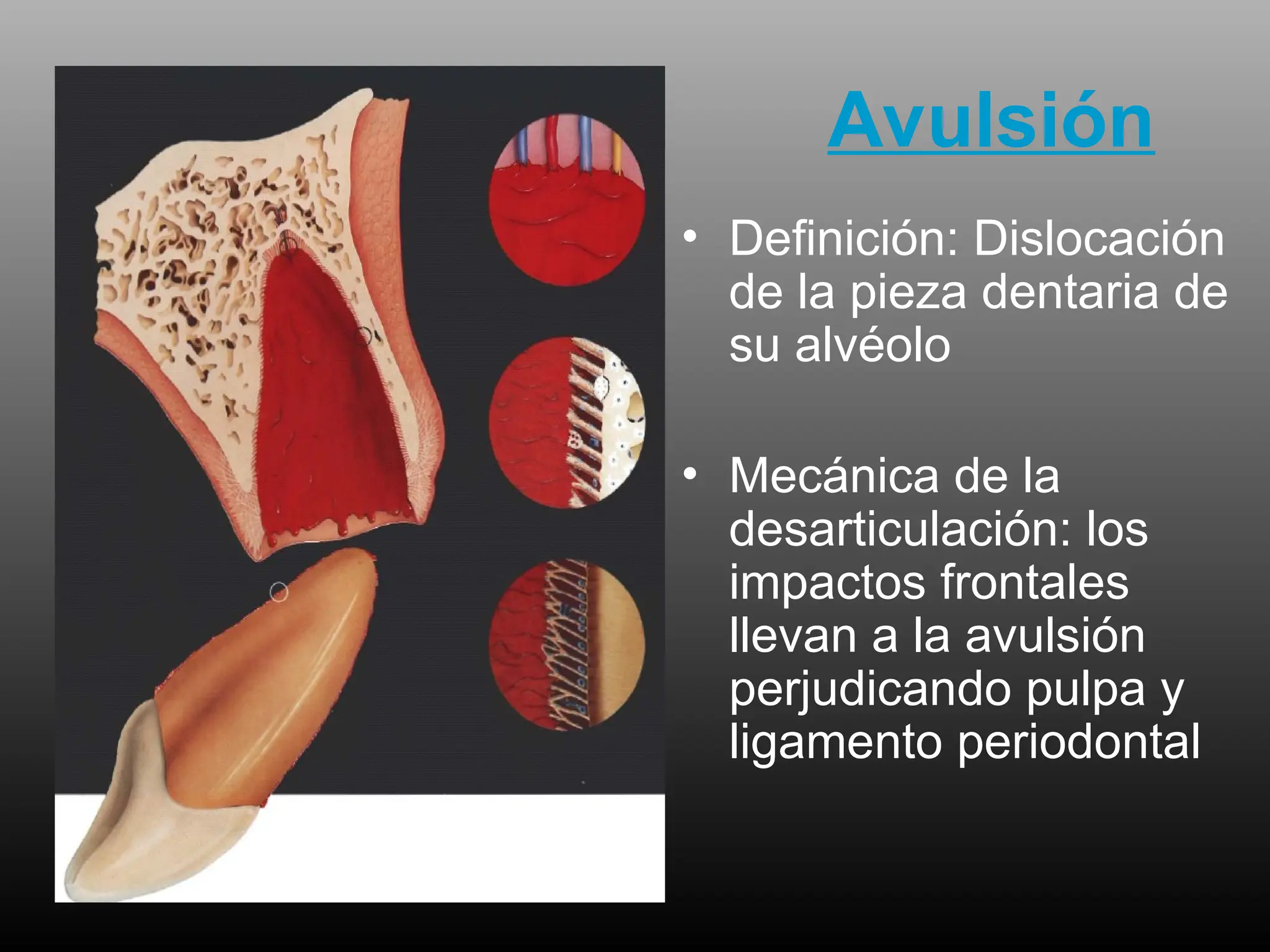 TRAUMATISMOS DENTALES: AVULSION DENTAL | PPT
