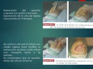 Avulsión ungueal y matricectomía total | PPTX