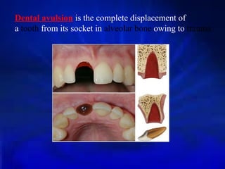 Avulsion | PPT