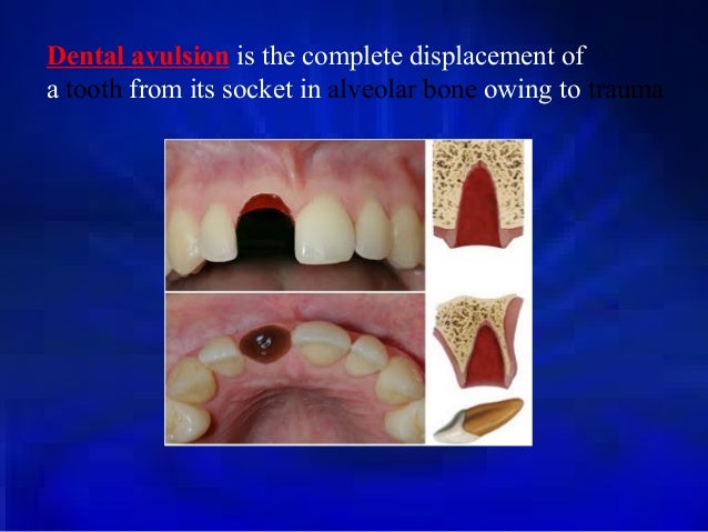 Avulsion
