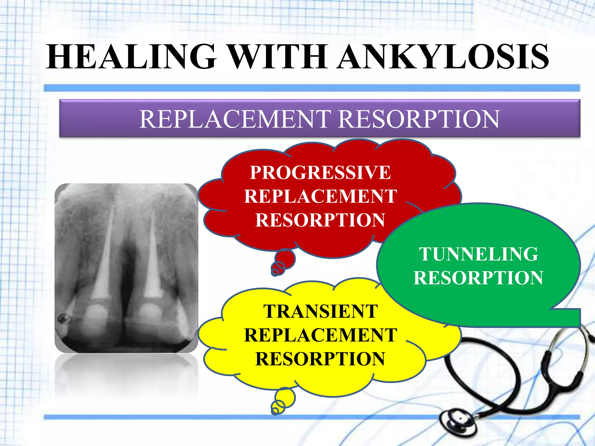 Avulsion | PPTX | Dental Health | Diseases and Conditions
