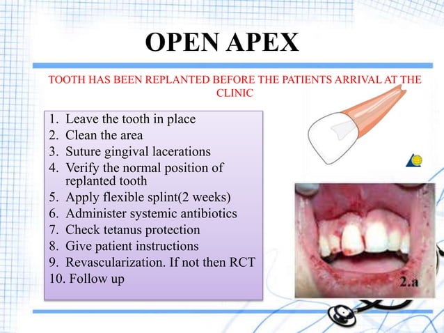 Avulsion | PPTX | Dental Health | Diseases and Conditions