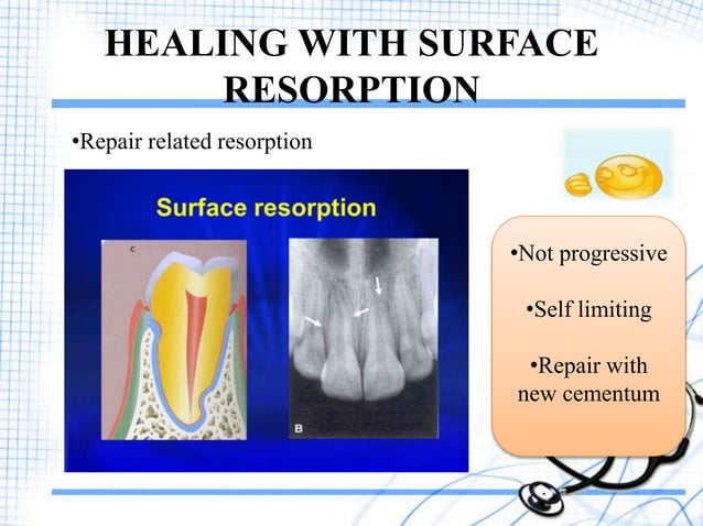 Avulsion | PPTX | Dental Health | Diseases and Conditions
