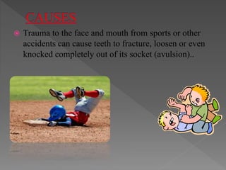 Avulsion | PPT