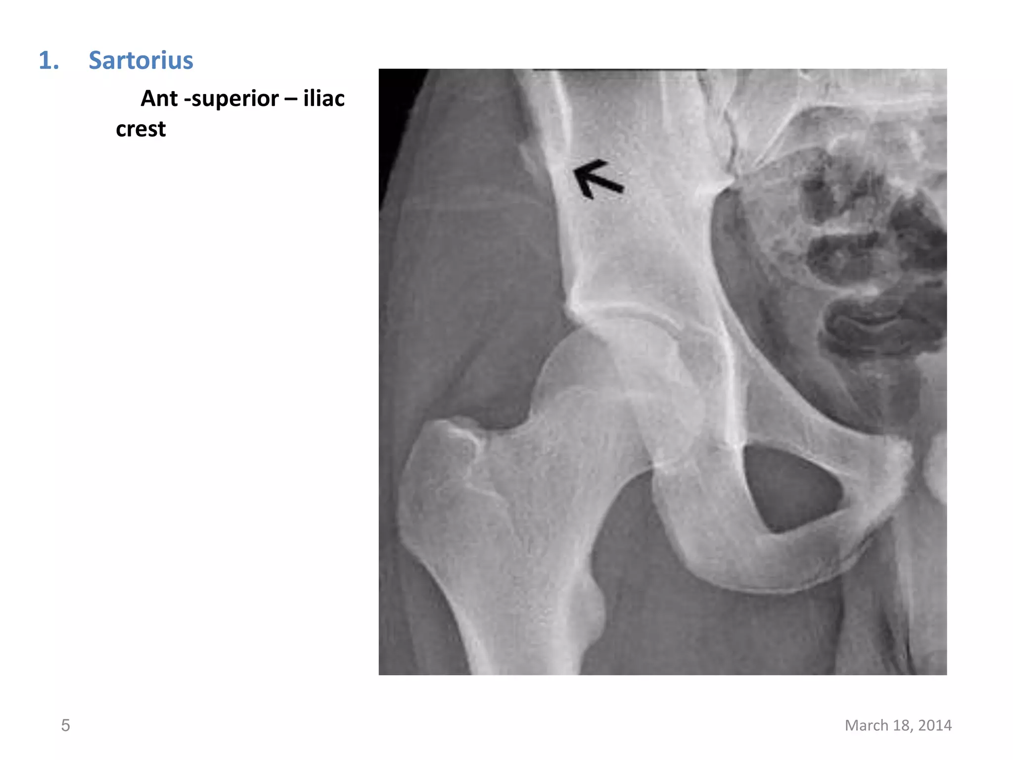 Avulsion fractures | PPTX