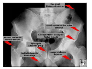 Avulsion fractures | PPT