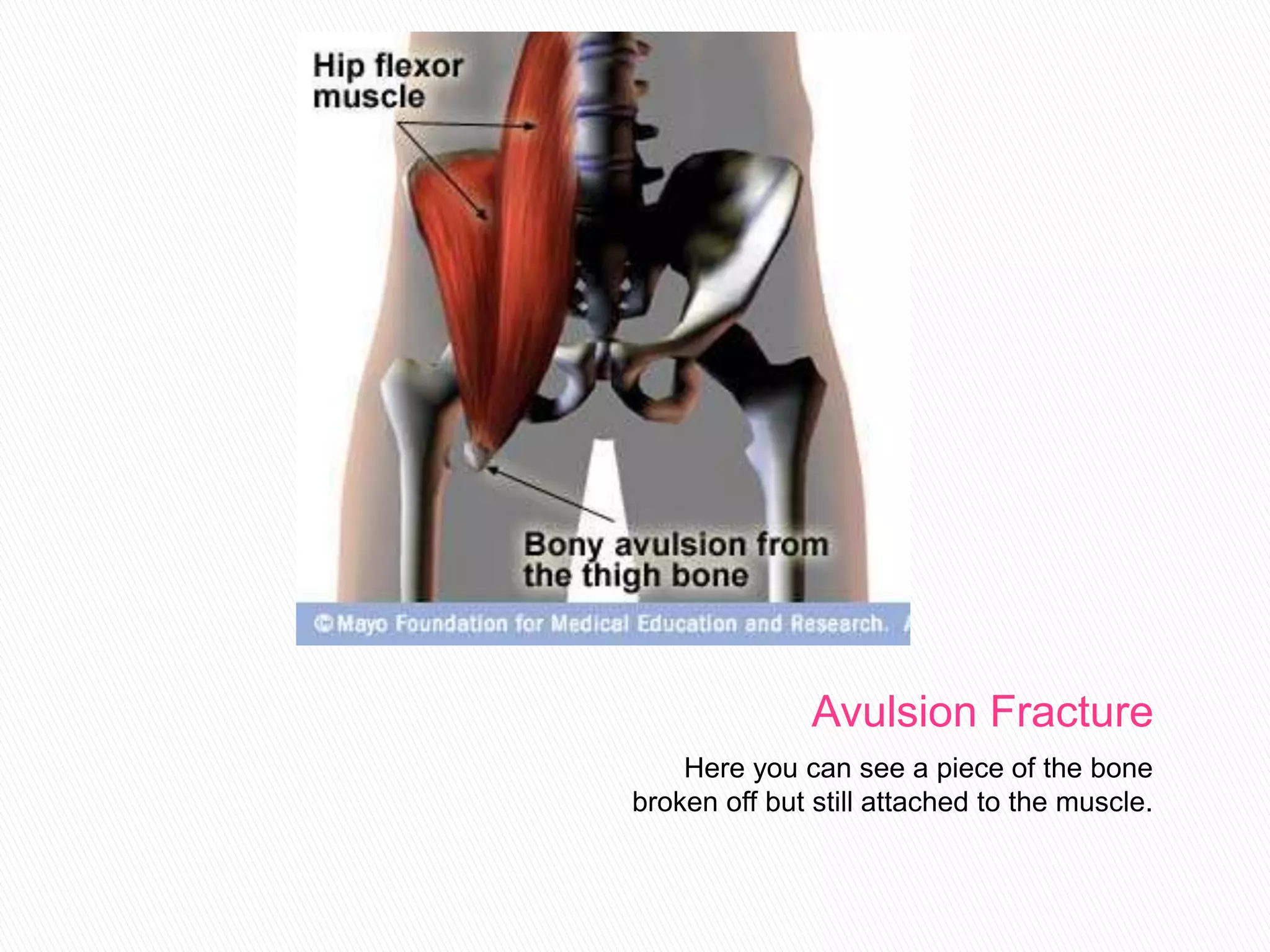 Avulsion fractures ppt ashley and sarah musculo[1] | PPTX