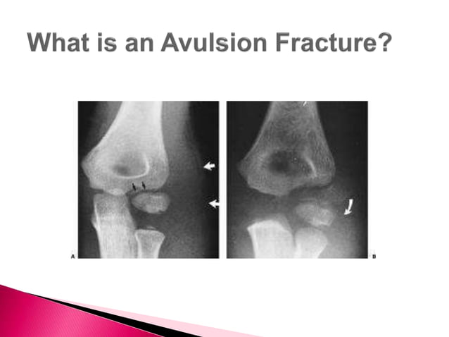 Avulsion fractures ppt ashley and sarah musculo[1] | PPT