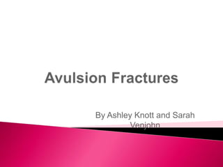 Avulsion fractures ppt [1] | PPTX