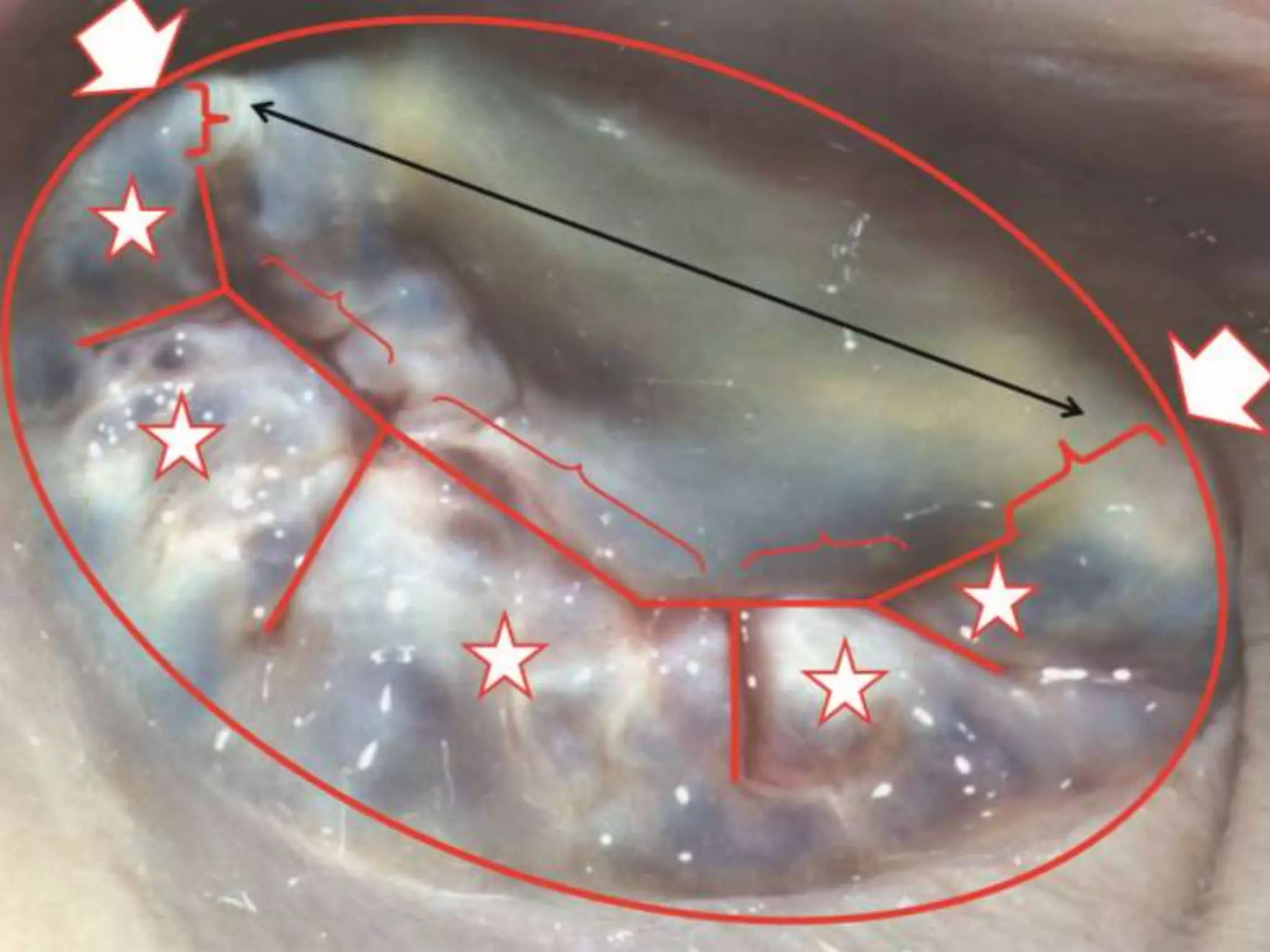 Atrioventricular valves (Mitral and Tricuspid) - Surgical anatomy | PPTX