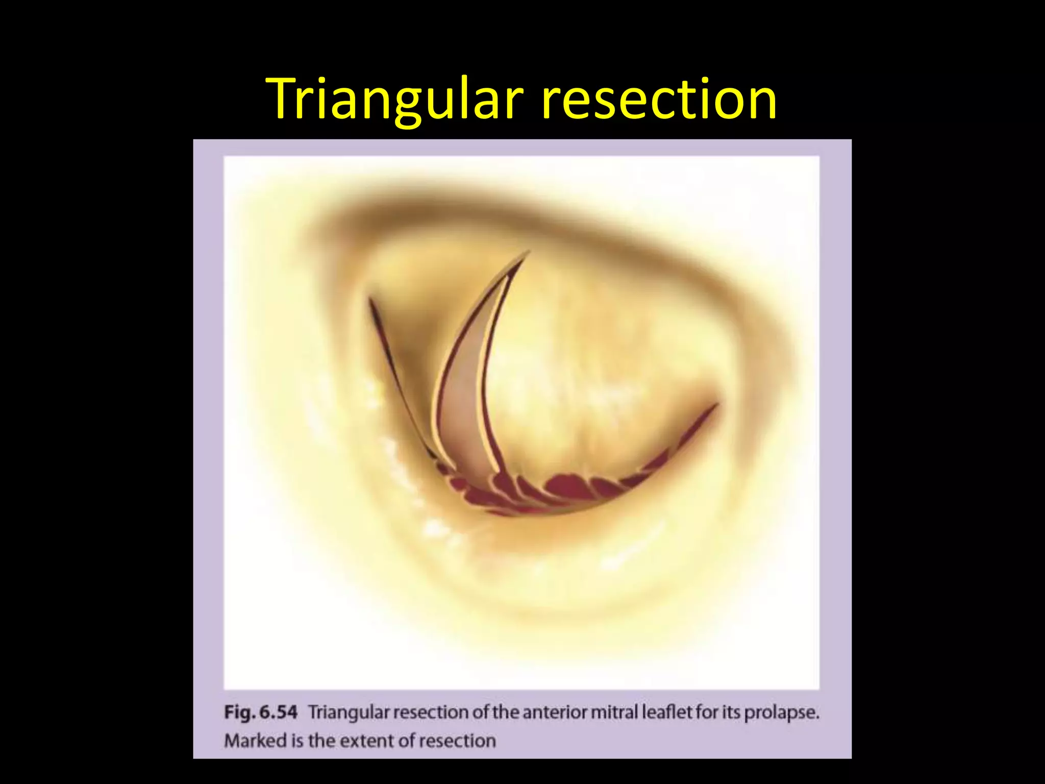 Atrioventricular valves (Mitral and Tricuspid) - Surgical anatomy | PPTX