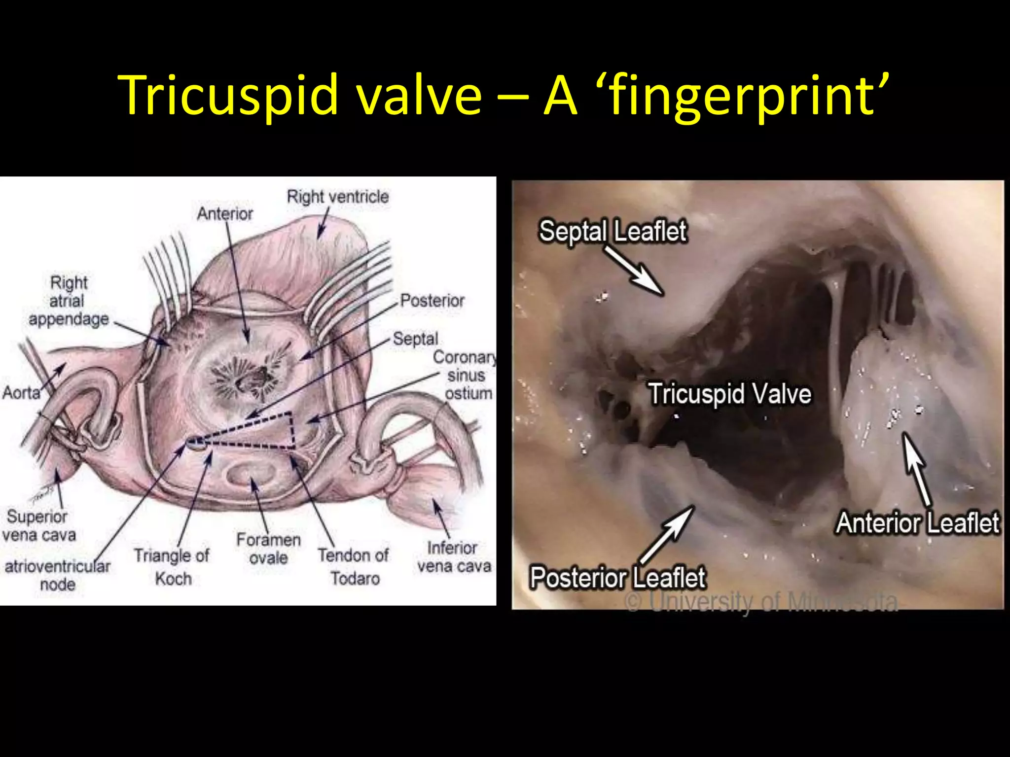 Atrioventricular valves (Mitral and Tricuspid) - Surgical anatomy | PPTX