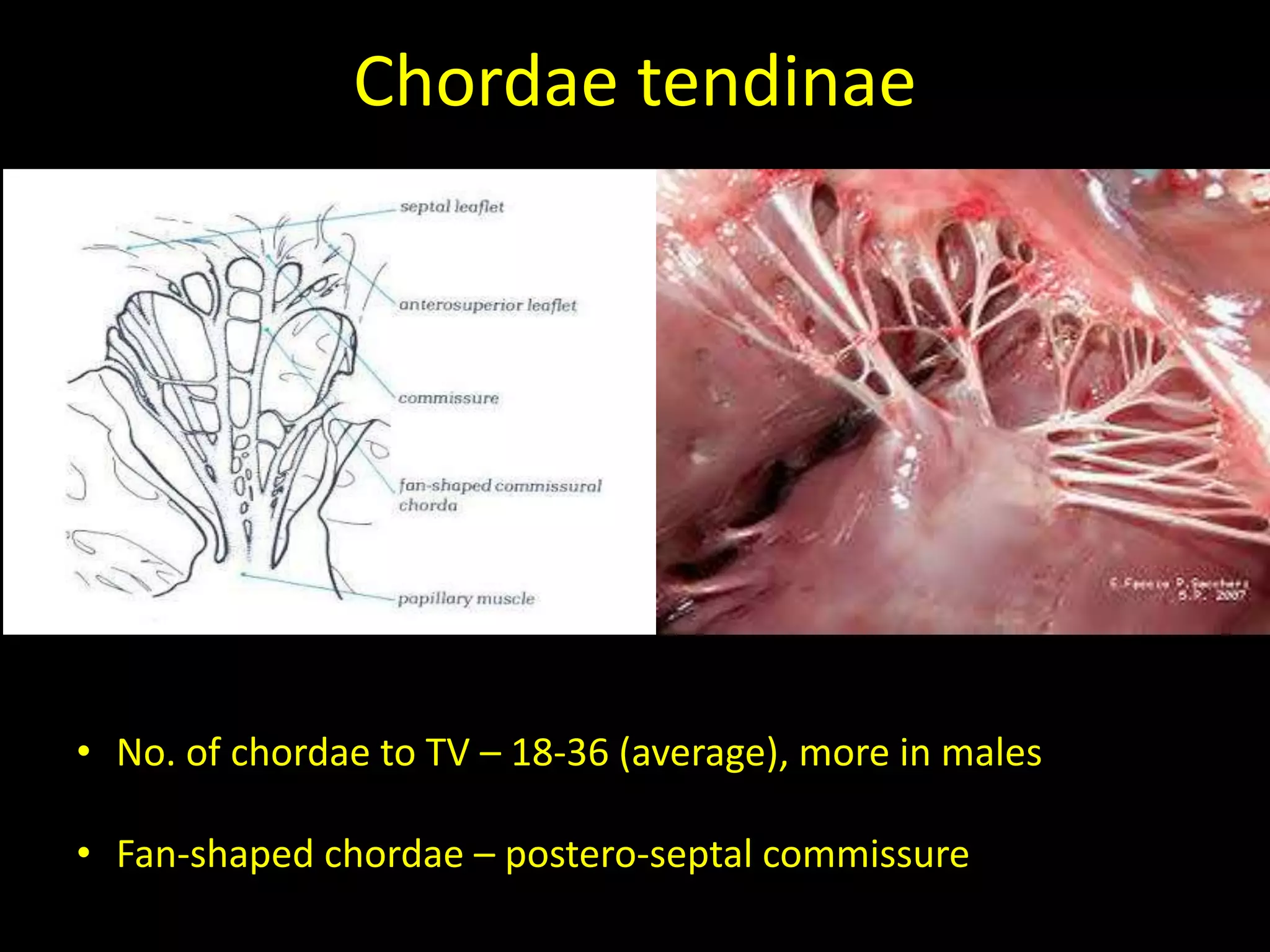 Atrioventricular valves (Mitral and Tricuspid) - Surgical anatomy | PPTX