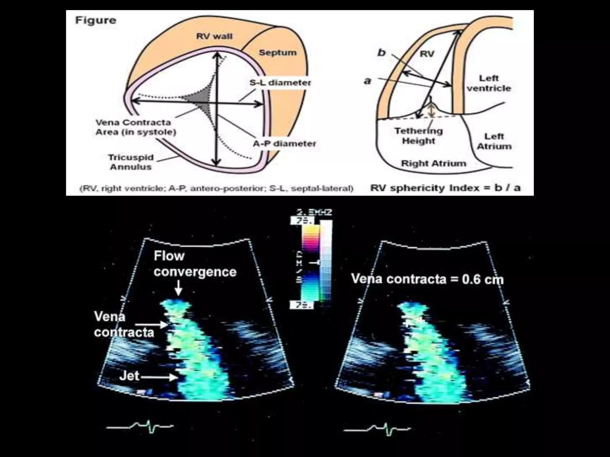 Atrioventricular valves (Mitral and Tricuspid) - Surgical anatomy | PPTX