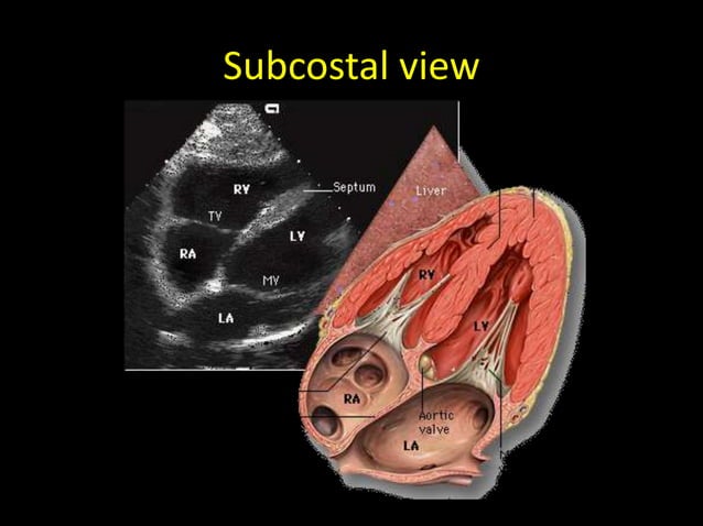 Atrioventricular valves (Mitral and Tricuspid) - Surgical anatomy | PPT ...