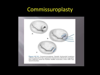 Atrioventricular valves (Mitral and Tricuspid) - Surgical anatomy | PPTX