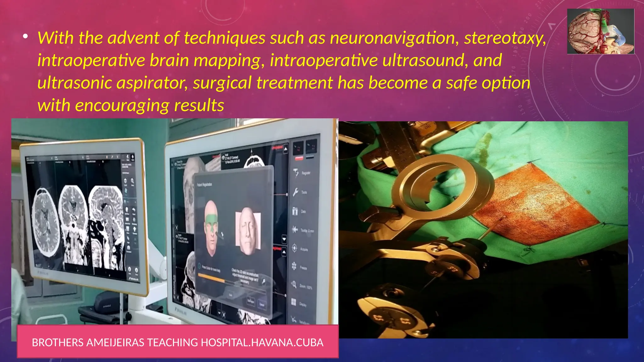 Awake Craniotomy with endoscopic support, guided by intraoperative ...