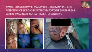Awake Craniotomy with endoscopic support, guided by intraoperative ultrasound, Imeka ...