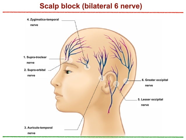 Awake craniotomy | PDF