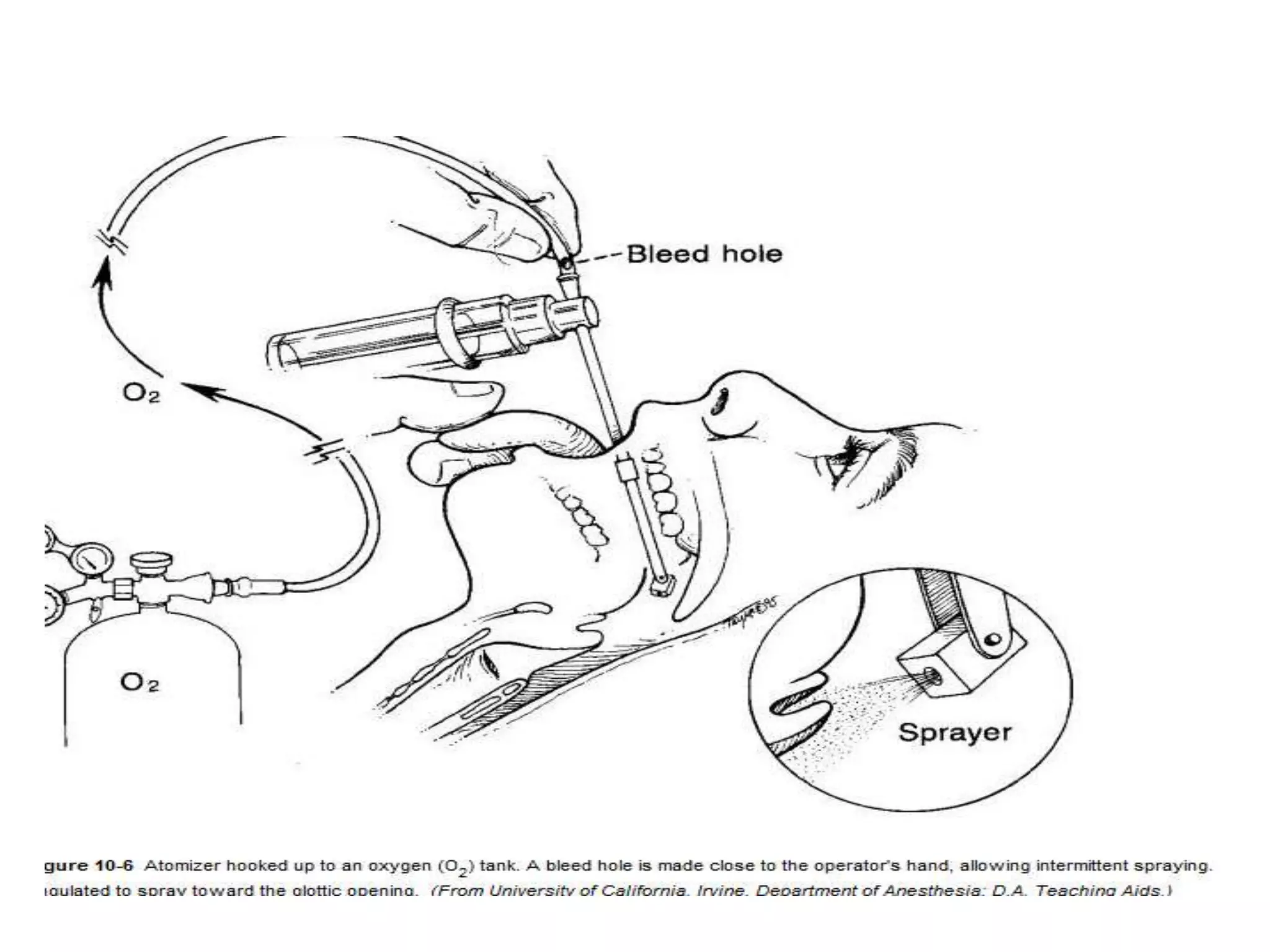 Awake intubation | PPTX