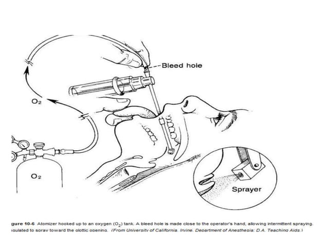 Awake intubation | PPTX
