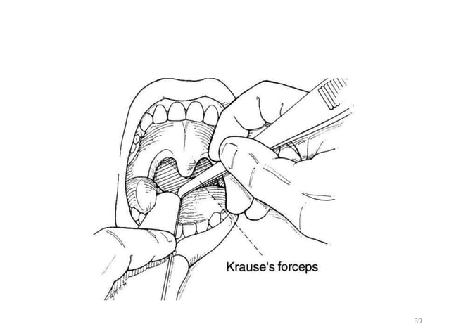 Awake intubation | PPTX