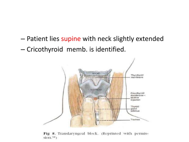 Awake intubation | PPTX