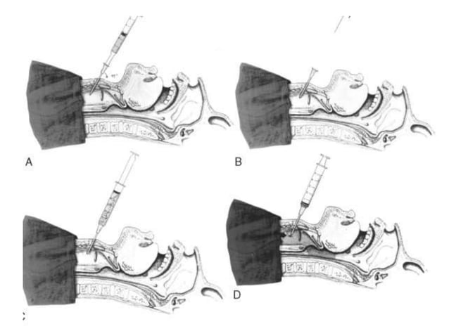 Awake intubation | PPTX