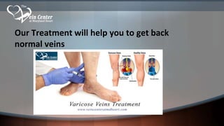 Awareness for preventing varicose veins | PPTX