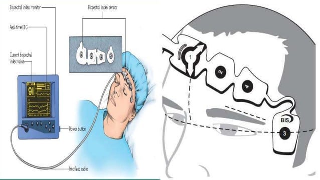 Awareness under anaesthesia | PPTX | Sleep Disorders | Diseases and ...