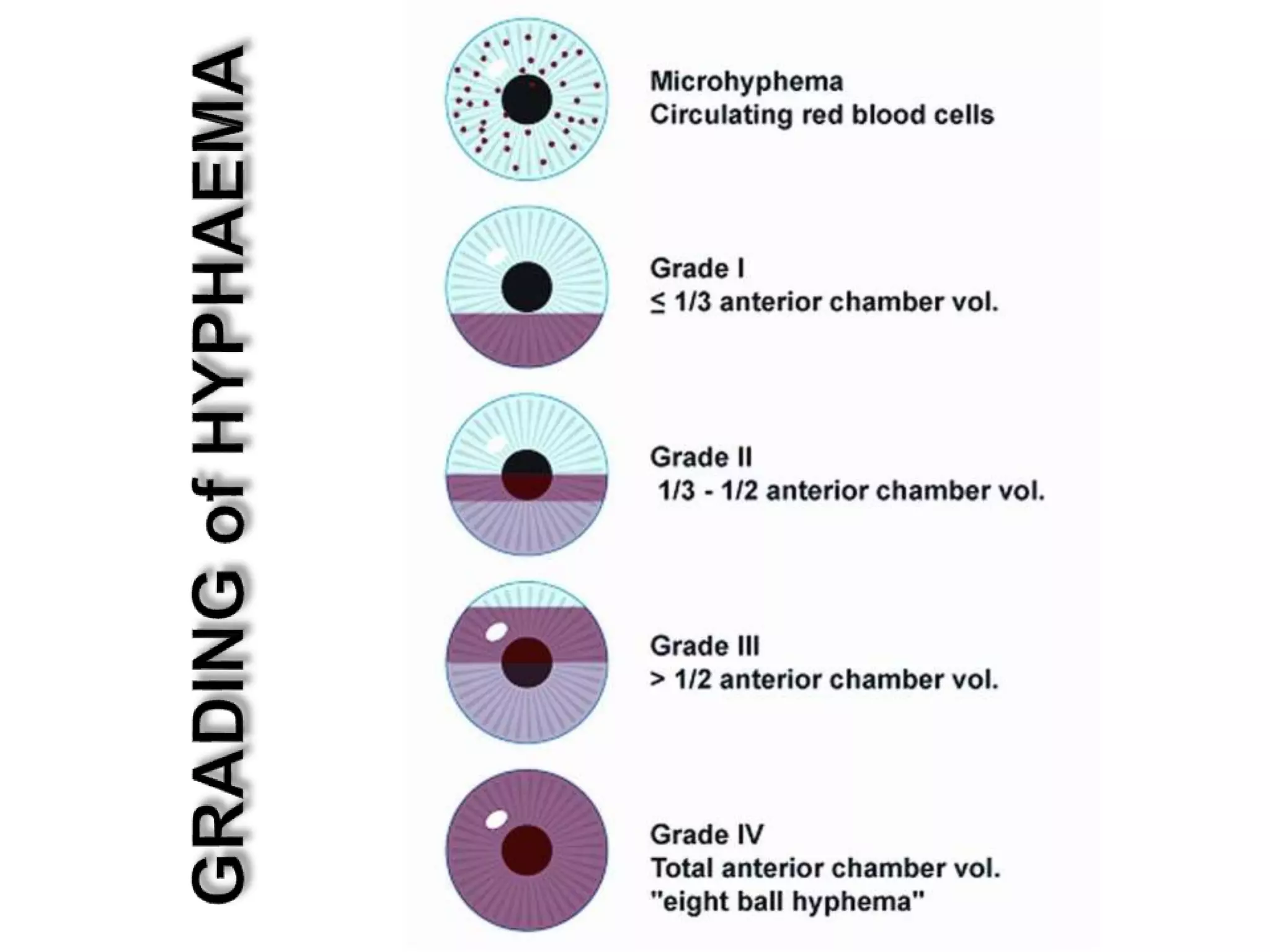 Management of Traumatic Iridodialysis with Hyphaema.pptx