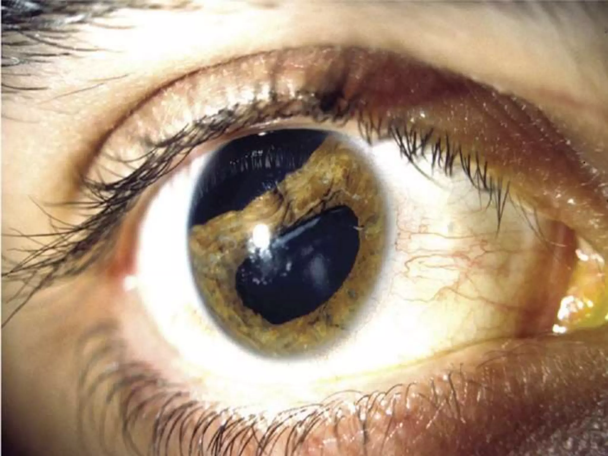 Management of Traumatic Iridodialysis with Hyphaema.pptx