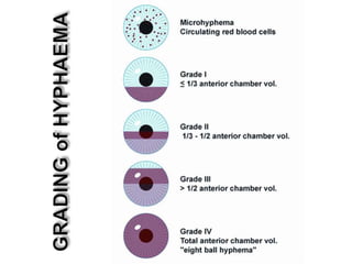 Management of Traumatic Iridodialysis with Hyphaema.pptx