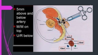 Axillary Block | PPTX