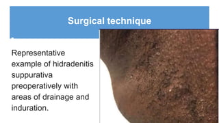 Axillary Hidradenitis Reconstruction Using a Dermal Regeneration ...