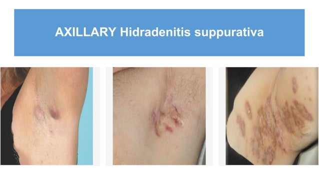 Axillary Hidradenitis Reconstruction Using a Dermal Regeneration ...