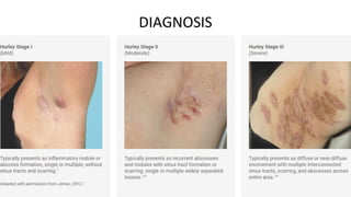 Axillary Hidradenitis Reconstruction Using a Dermal Regeneration ...