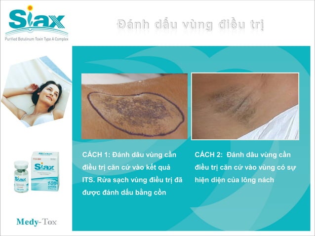 Axillary hyperhidrosis treatment procedure with bo nt a | PPT